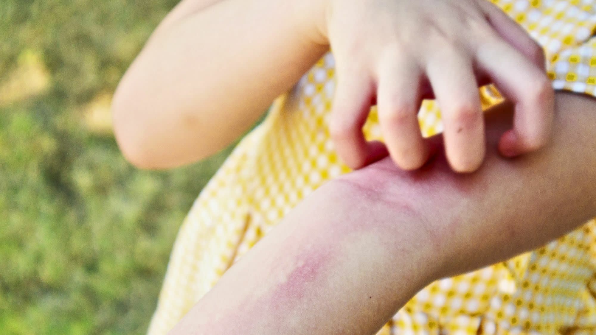 How to Handle Bed Bug Bites on Kids