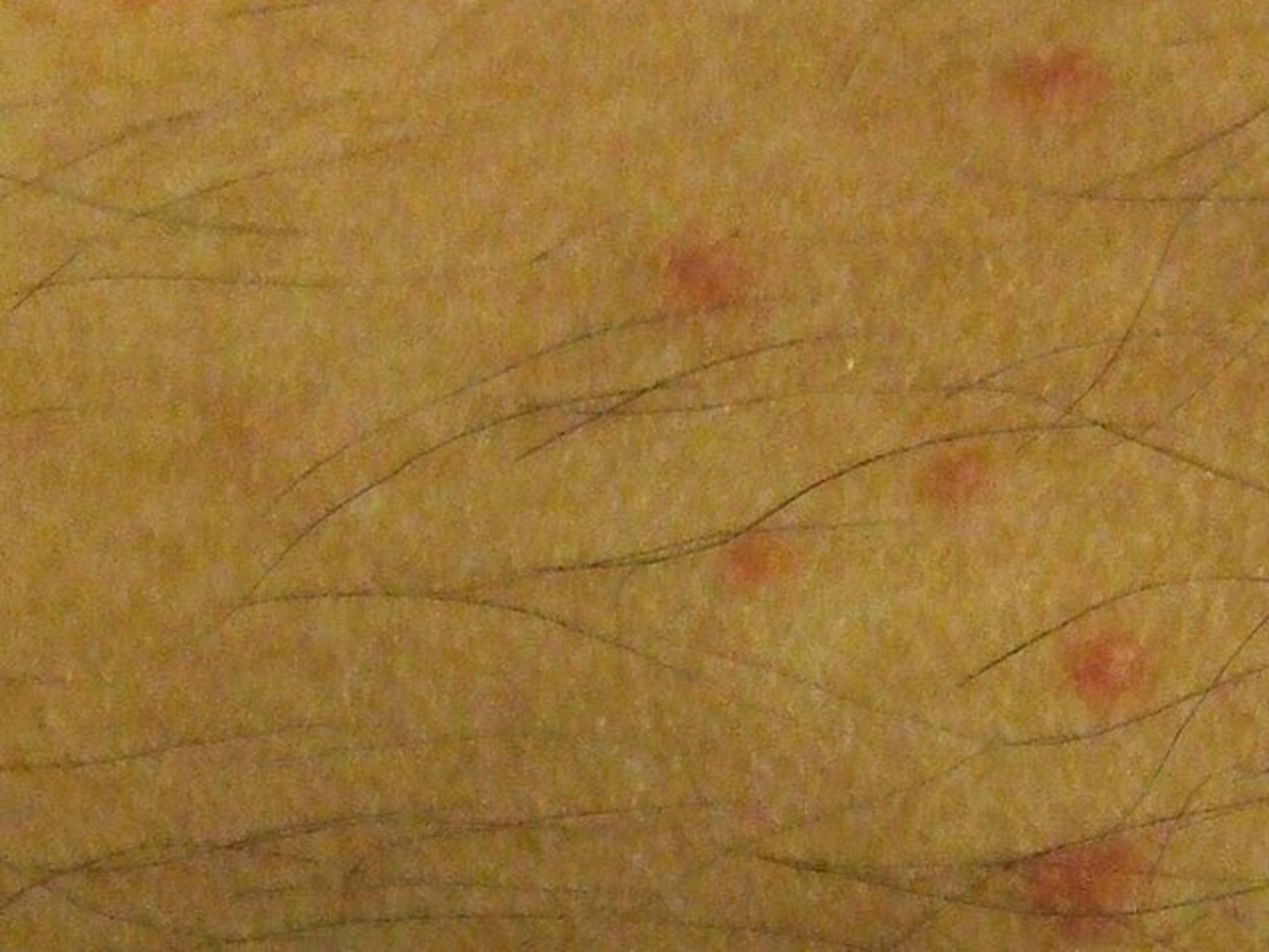 Flea Bites on Humans: Symptoms, Treatment, and More - Dengarden